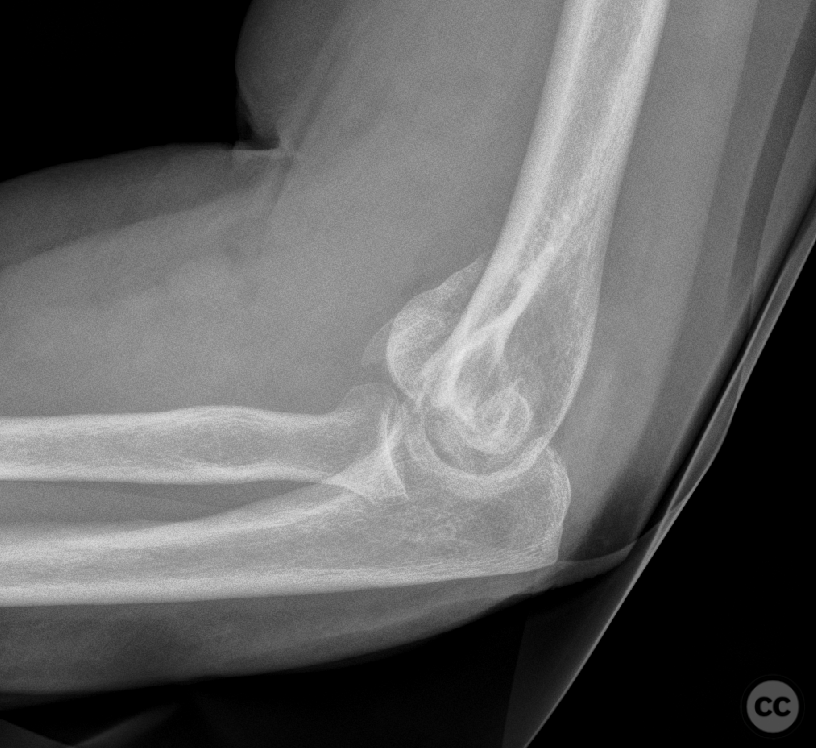Fracture hemiarthroplasty distal humerus