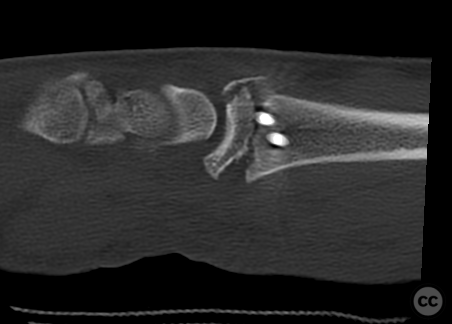 Malunion Salter III distal radius fracture dislocation