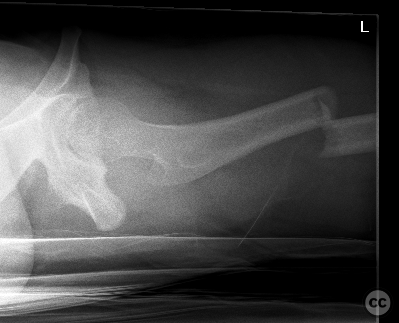 Simple transverse femoral shaft fracture