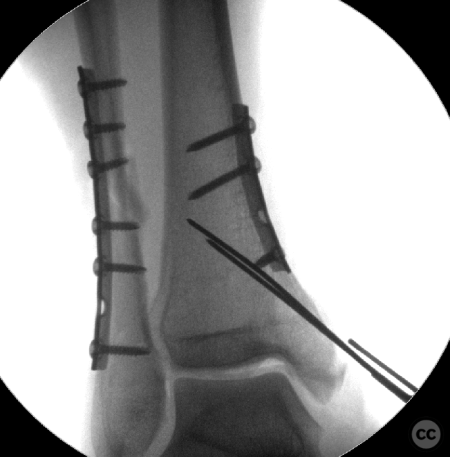 Mason III posterior malleolus fracture dislocation