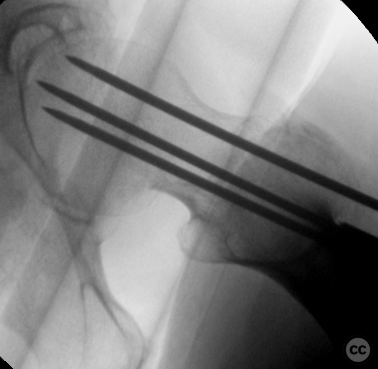 Cannulated screw fixation of a Garden I subcapital femoral neck fracture