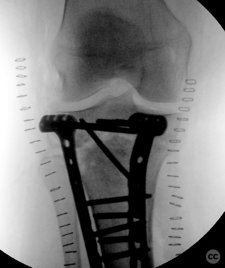 Varus hyperextension tibial plateau fracture