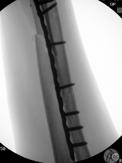 Henry's approach to a segmental radial shaft fracture
