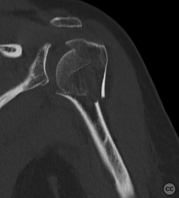 Impacted anatomical neck of humerus fracture with TM fragment