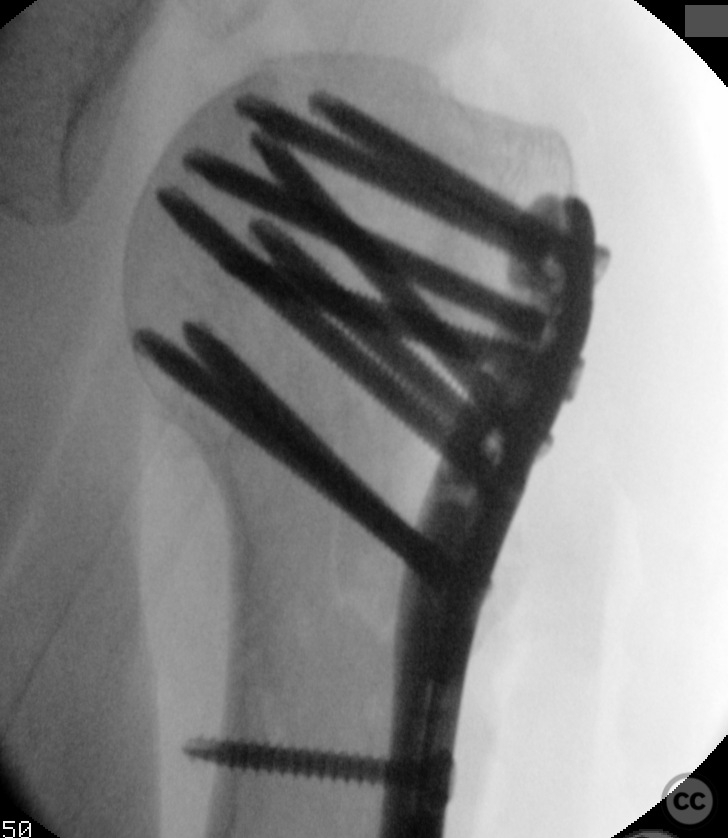 Impacted anatomical neck of humerus fracture with TM fragment