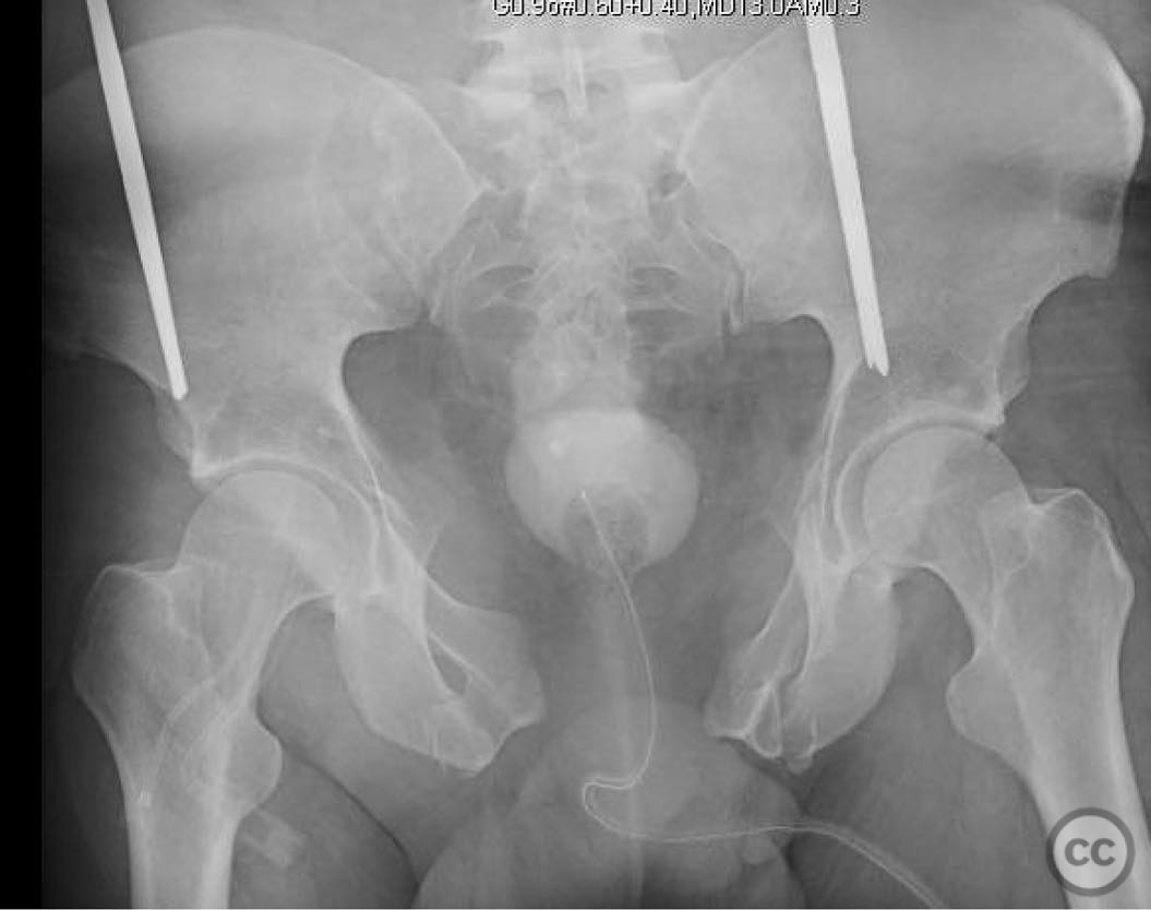 Complex Bilateral Pelvic Ring Injury with APC2 and APC3 Patterns