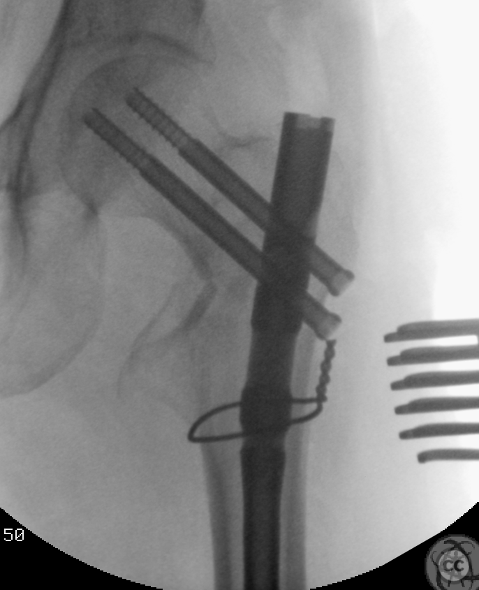Multifragment intertrochanteric femur fracture with subtrochanteric ...