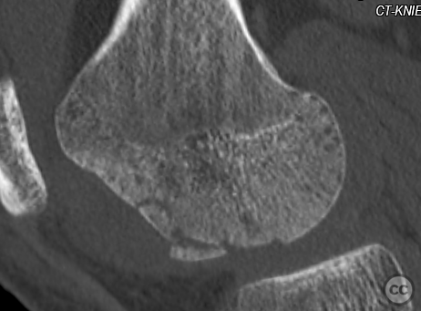 Destructive osteochondral fracture of the lateral femoral condyle ...