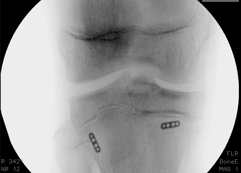 Mayer McKeevers II-III paediatric tibial eminence avulsion fracture