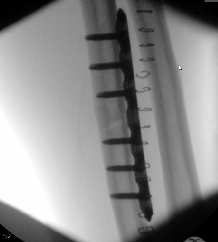 Essex-Lopresti fracture-dislocation