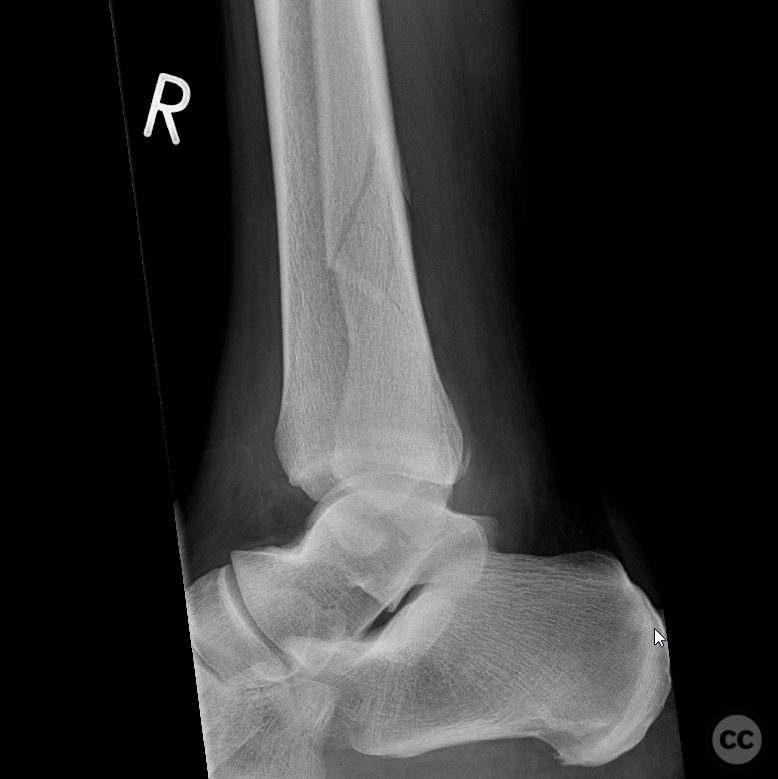 Pronation Abduction (PAb) Weber C / Herscovici B bimalleolar ankle fracture