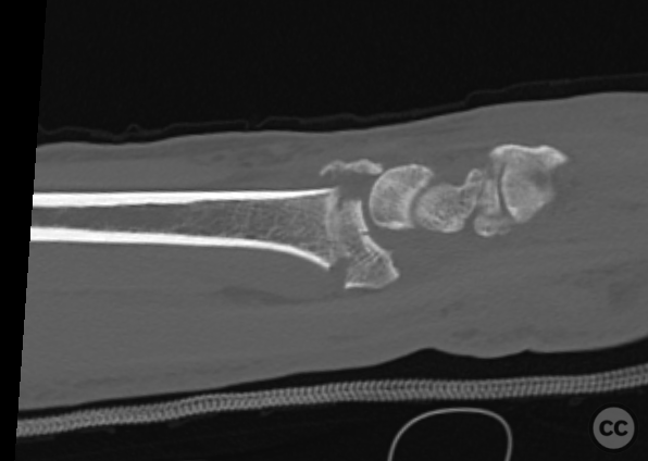270deg plating of a comminuted distal radius fracture