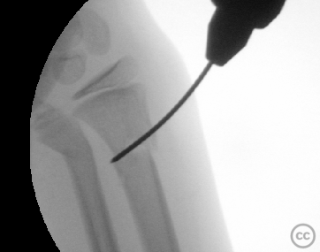 Kapandji intra-focal reduction of a distal radius fracture