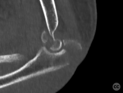 Transolecranon Dubberly 2B fracture dislocation
