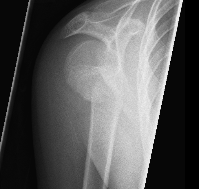 Proximal humerus metaphyseal fracture