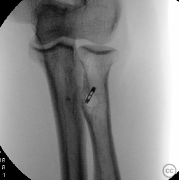 Distal biceps bicortical endobutton fixation