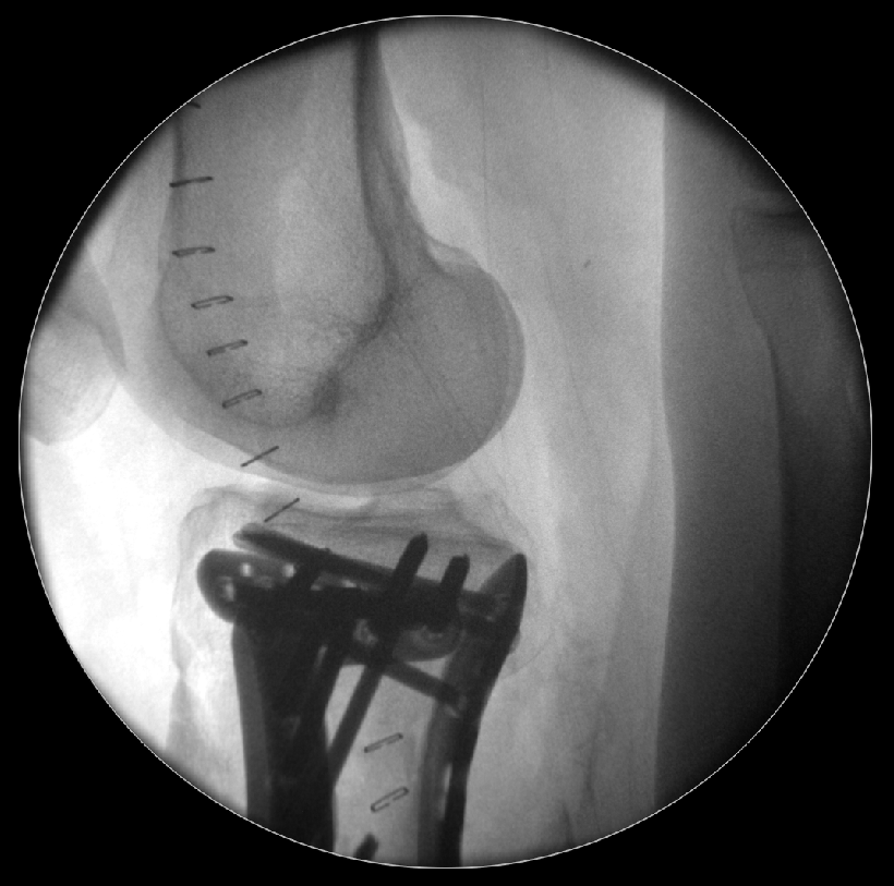 Schatzker VI tri-condylar fracture with pseudo PLC disruption