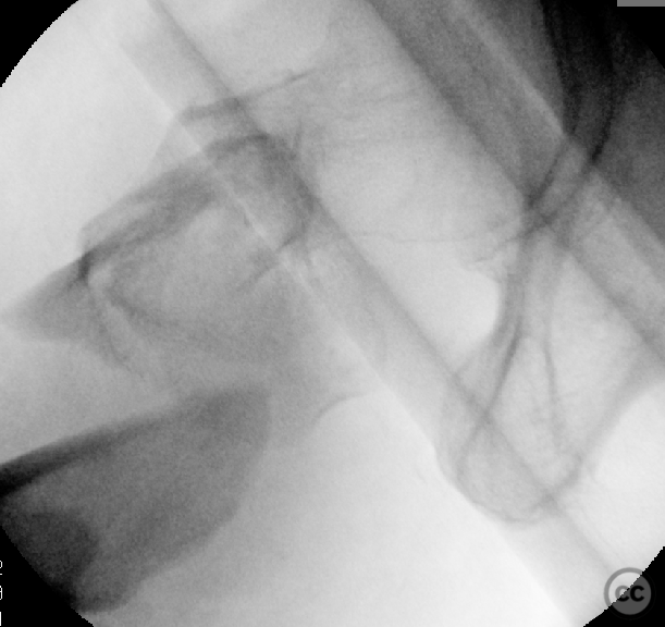 Failure of fixation - Gamma nail cut-out and arthroplasty revision