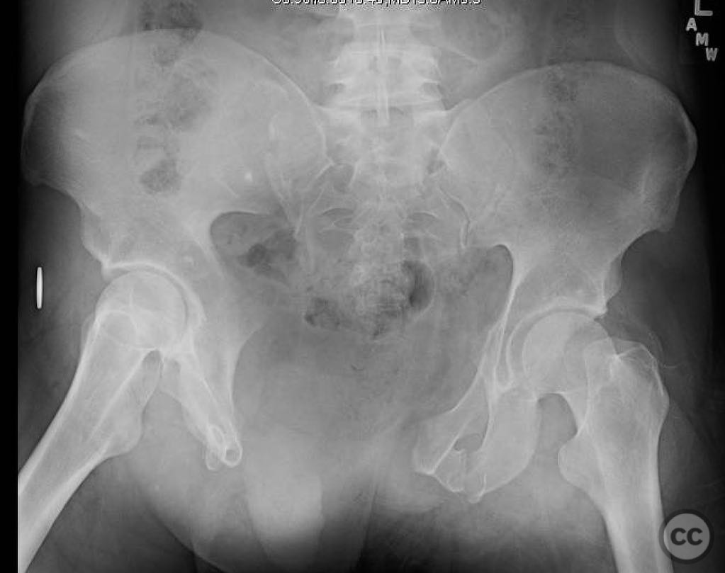 Complex Bilateral Pelvic Ring Injury with APC2 and APC3 Patterns