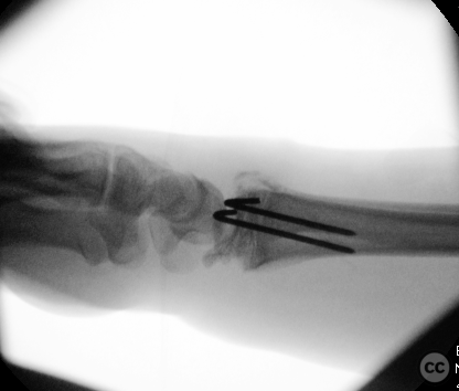 Malunion Salter III distal radius fracture dislocation