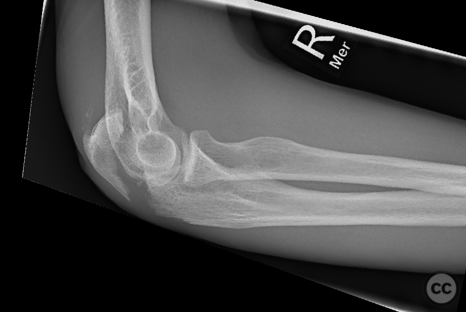 Fixation failure of a proximal olecranon fracture, salvaged with suture ...