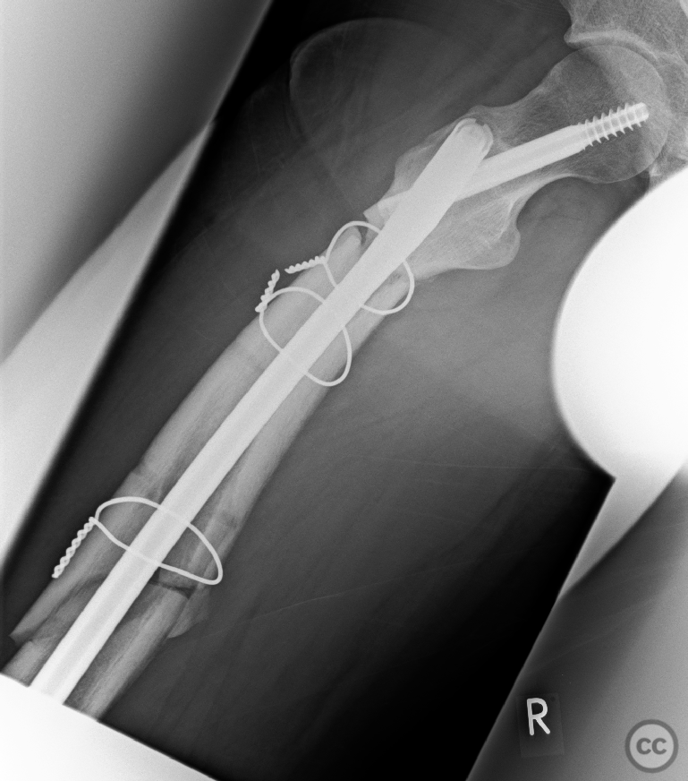 Closed segmental comminuted femoral fracture