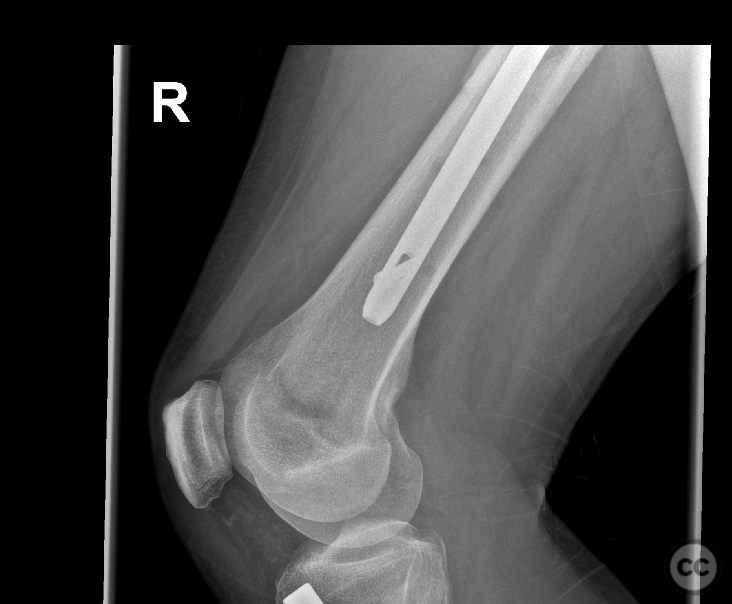 Closed segmental comminuted femoral fracture