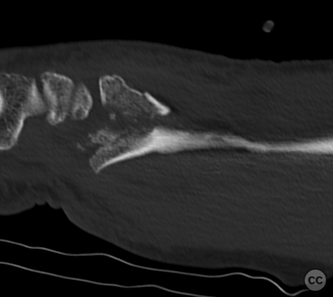 Complex comminuted and impacted distal radius fracture