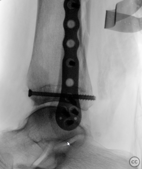 Trimalleolar fracture dislocation Lauge-Hansen PER Weber C
