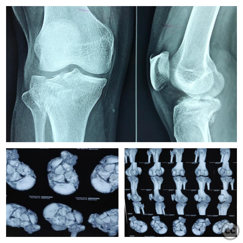 Comminuted lateral tibial plateau fracture