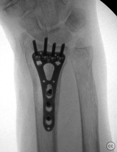 Volar Barton's volar rim fracture distal radius