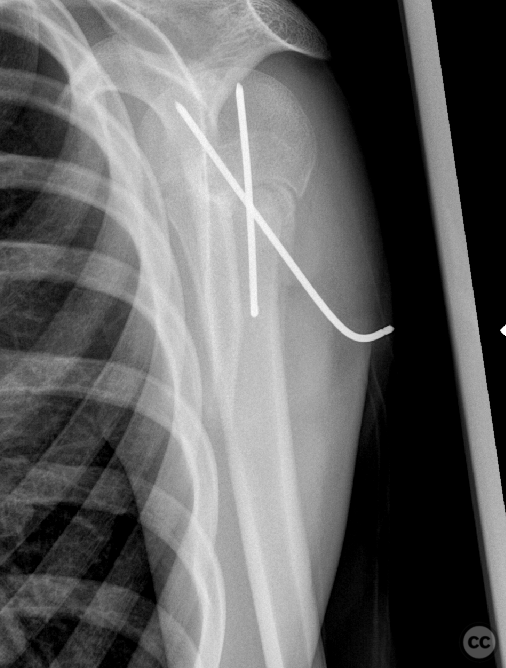 Salter 2 proximal humerus fracture kapandji technique