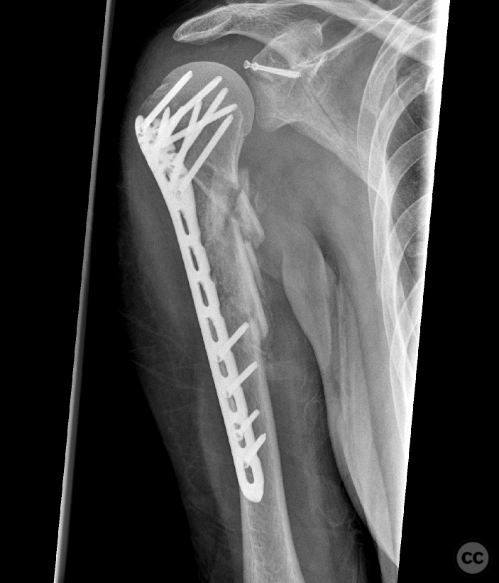 Multifragmentary Proximal Humerus Fracture with Scapula Fracture in a ...