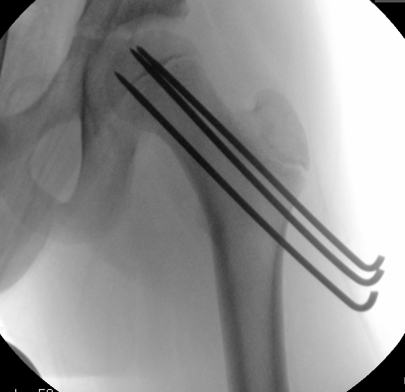 SCFE - Grade I - closed reduction and MIS osteosynthesis