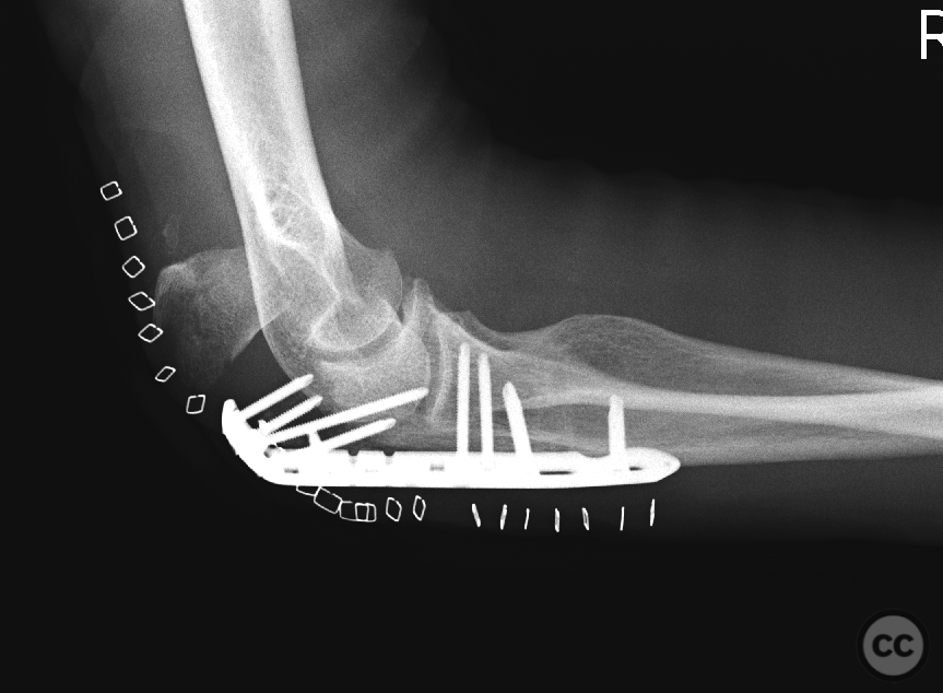 Fixation failure of a proximal olecranon fracture, salvaged with suture ...