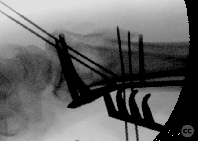 Complex comminuted and impacted distal radius fracture
