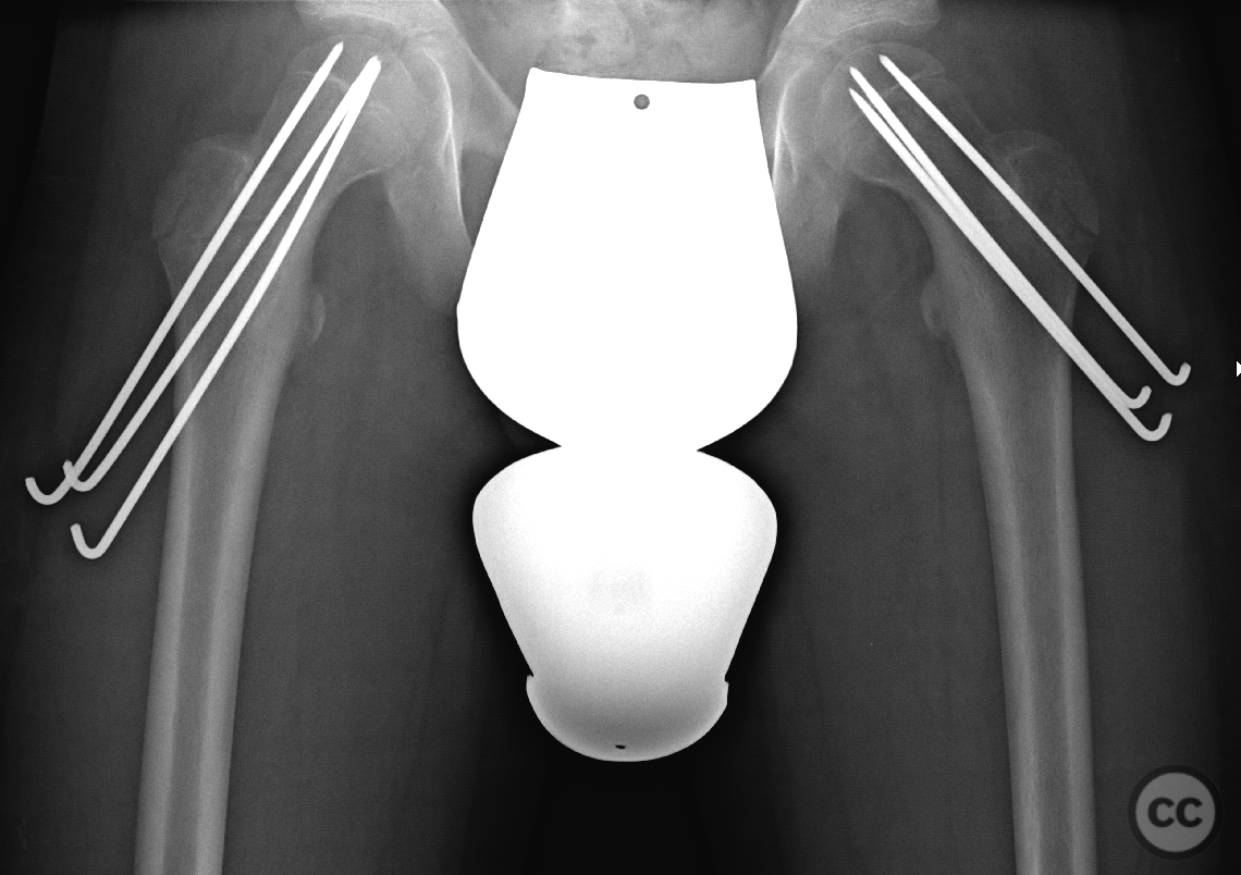 SCFE - Grade I - closed reduction and MIS osteosynthesis