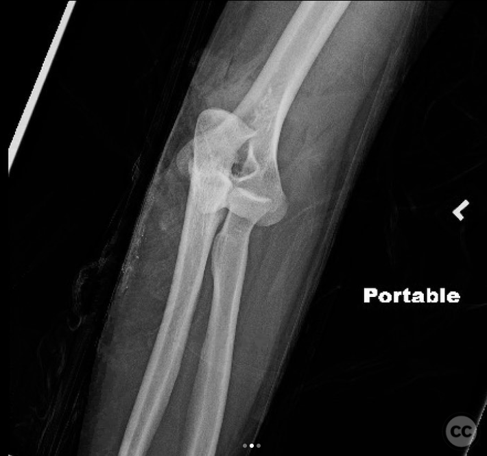 Internal Joint Stabilizer IJS® open posterior elbow dislocation