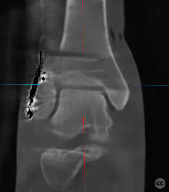 SER ankle injury with occult PITFL + deltoid instability