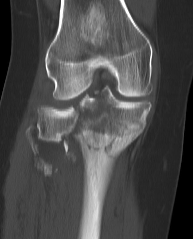 Schatzker VI tri-condylar fracture with pseudo PLC disruption