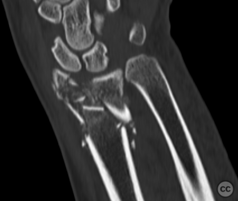 High energy C3 distal radius with metaphyseal defect