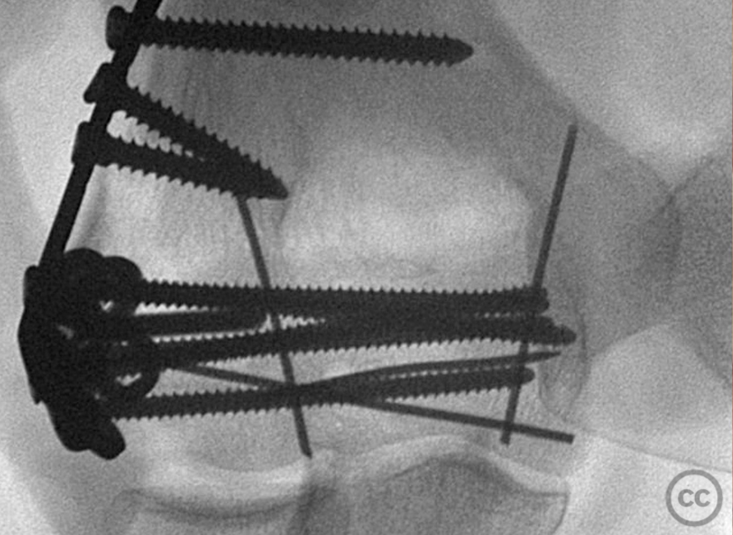 Dubberly 2B articular humerus fracture - skinny wire and radial plate ...