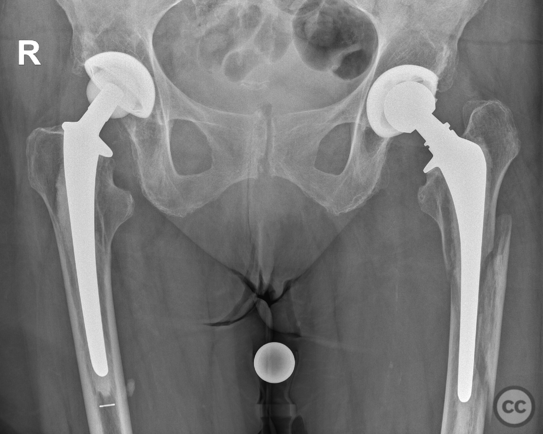 Vancouver B2 periprosthetic femur fracture - LCP broard curved