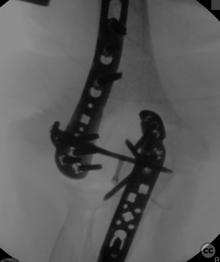 Transolecranon Dubberly 2B fracture dislocation