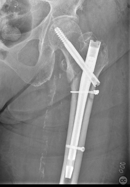Classical intertrochanteric fracture with reverse oblique extension