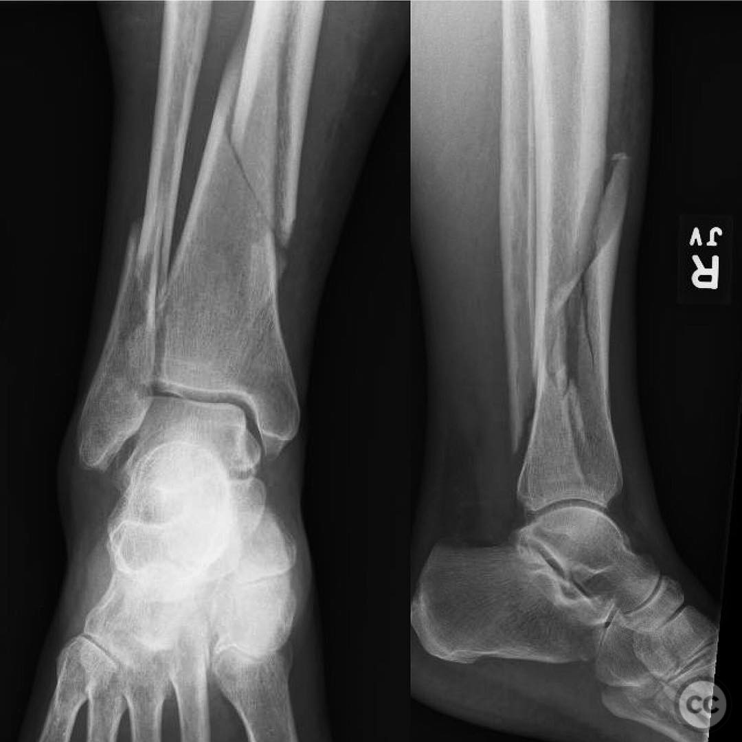 Distal Tibial Metaphyseal Fracture with Non-displaced Medial Malleolar ...