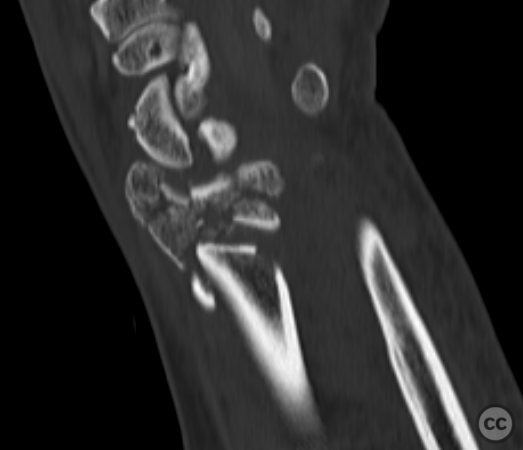 High energy C3 distal radius with metaphyseal defect