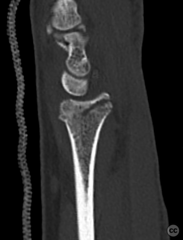 Operative Management of Chauffeur's Fracture with Intraarticular ...