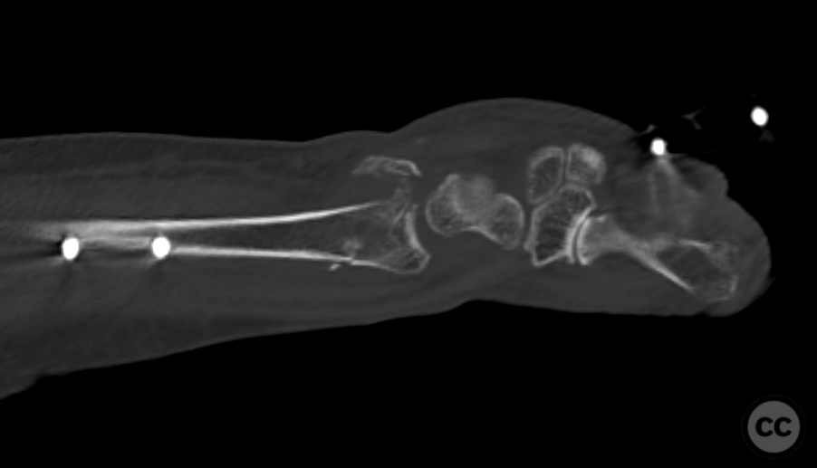 Radiocarpal distraction reduction technique for distal radius fracture