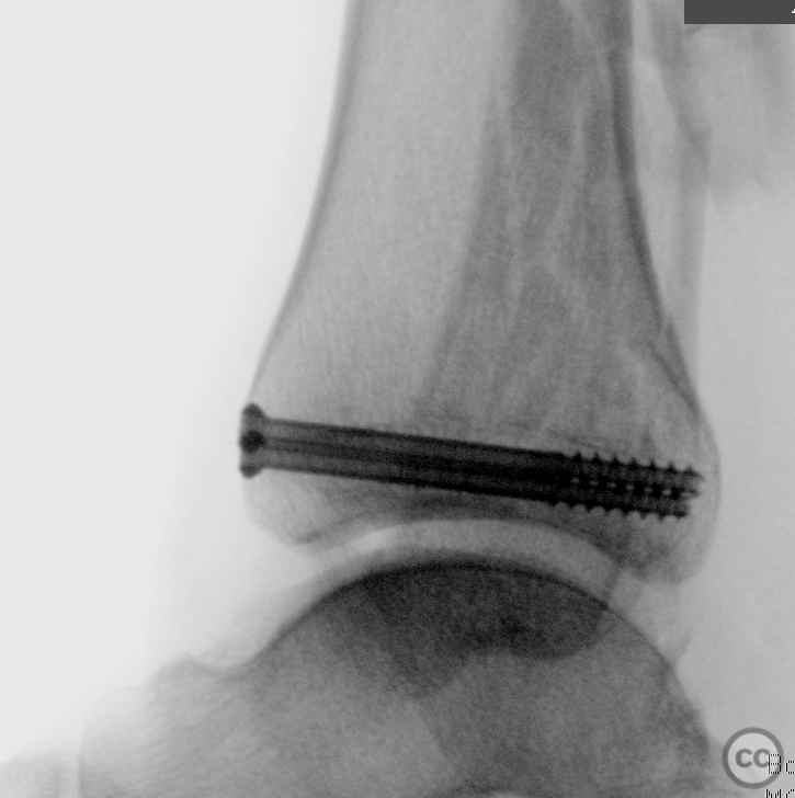 High-energy tibia and fibular fracture following a motorcycle accident